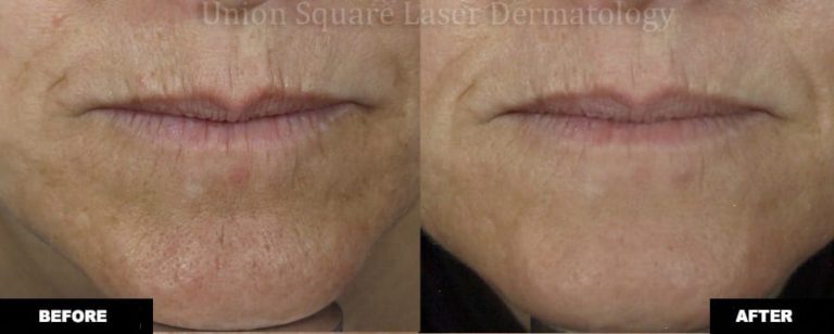 Fraxel ® Restore Dual - UnionDerm - The Art + Science of Skin