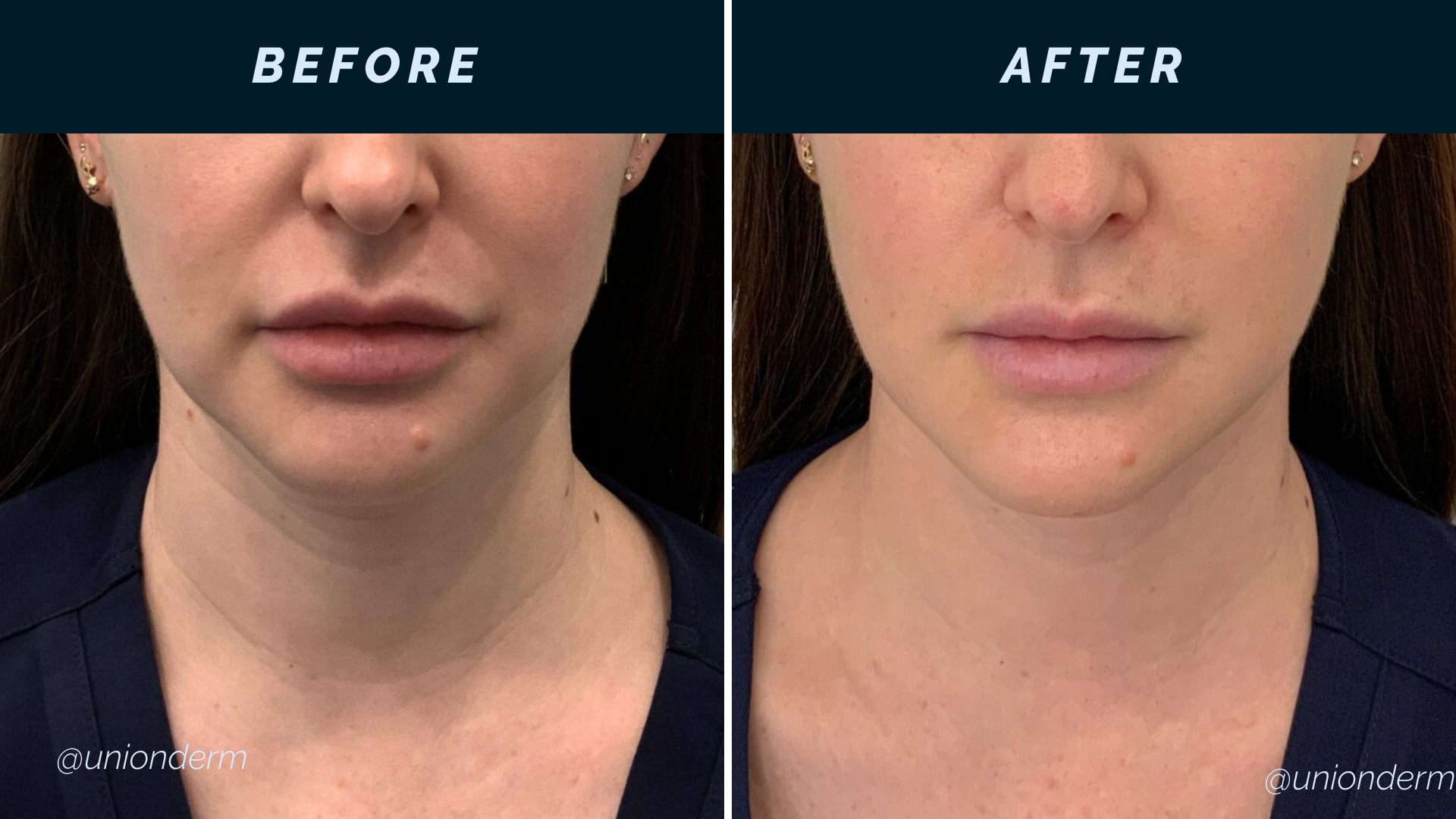 Non-Surgical Neck Treatments to Tighten & Rejuvenate | NYC
